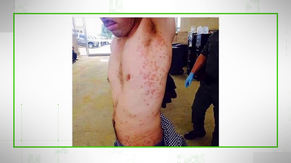 VERIFY: Claim says photo shows immigrant with 'smallpox' at southern ...