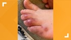 What are COVID toes? Skin condition may be linked to coronavirus ...