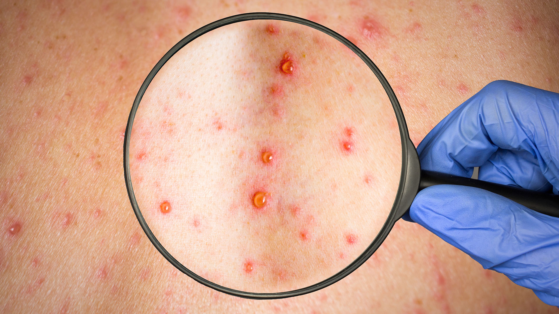Patients In Northwest Measles Outbreak Traveled To Hawaii Thv11 patients-in-northwest-measles-outbreak-traveled-to-hawaii-thv11