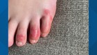 What are COVID toes? Skin condition may be linked to coronavirus ...