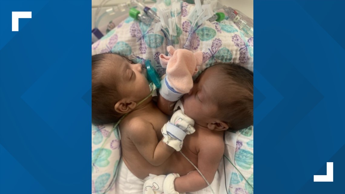 Fort Worth: Cook Children's conjoined twins separated | wusa9.com