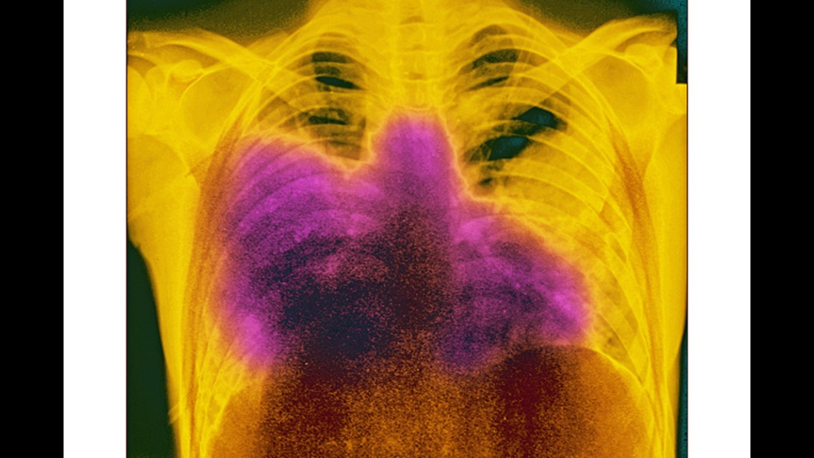 What You Need to Know About Legionnaires' Disease | wusa9.com