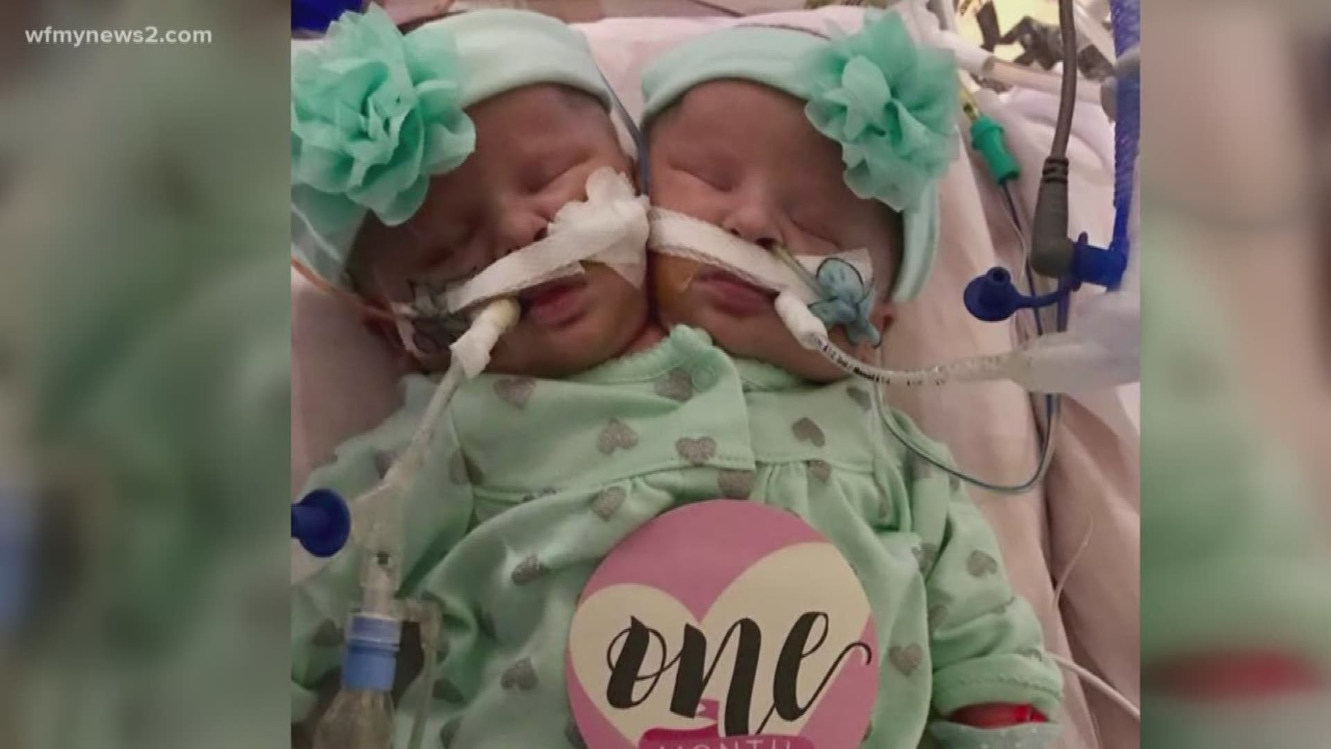 'Little Angels': Conjoined Twins Pass Away | wusa9.com