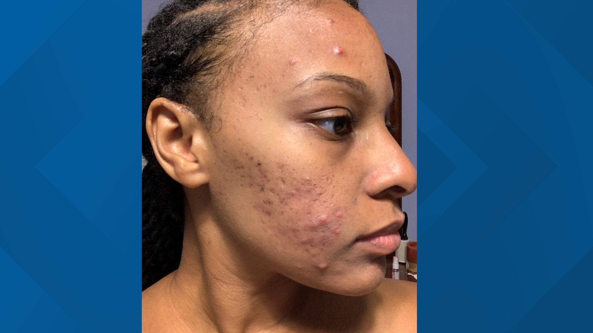 Coronavirus: Maskne comes from wearing face masks | wusa9.com