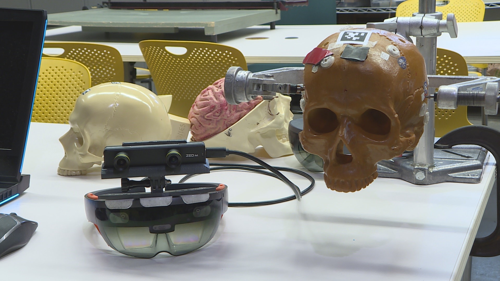 Virtual reality platform helps with brain surgery | wusa9.com