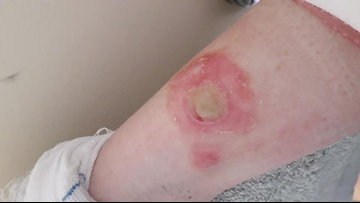 VERIFY: Here's why the 'Deodorant Challenge' causes permanent burn ...