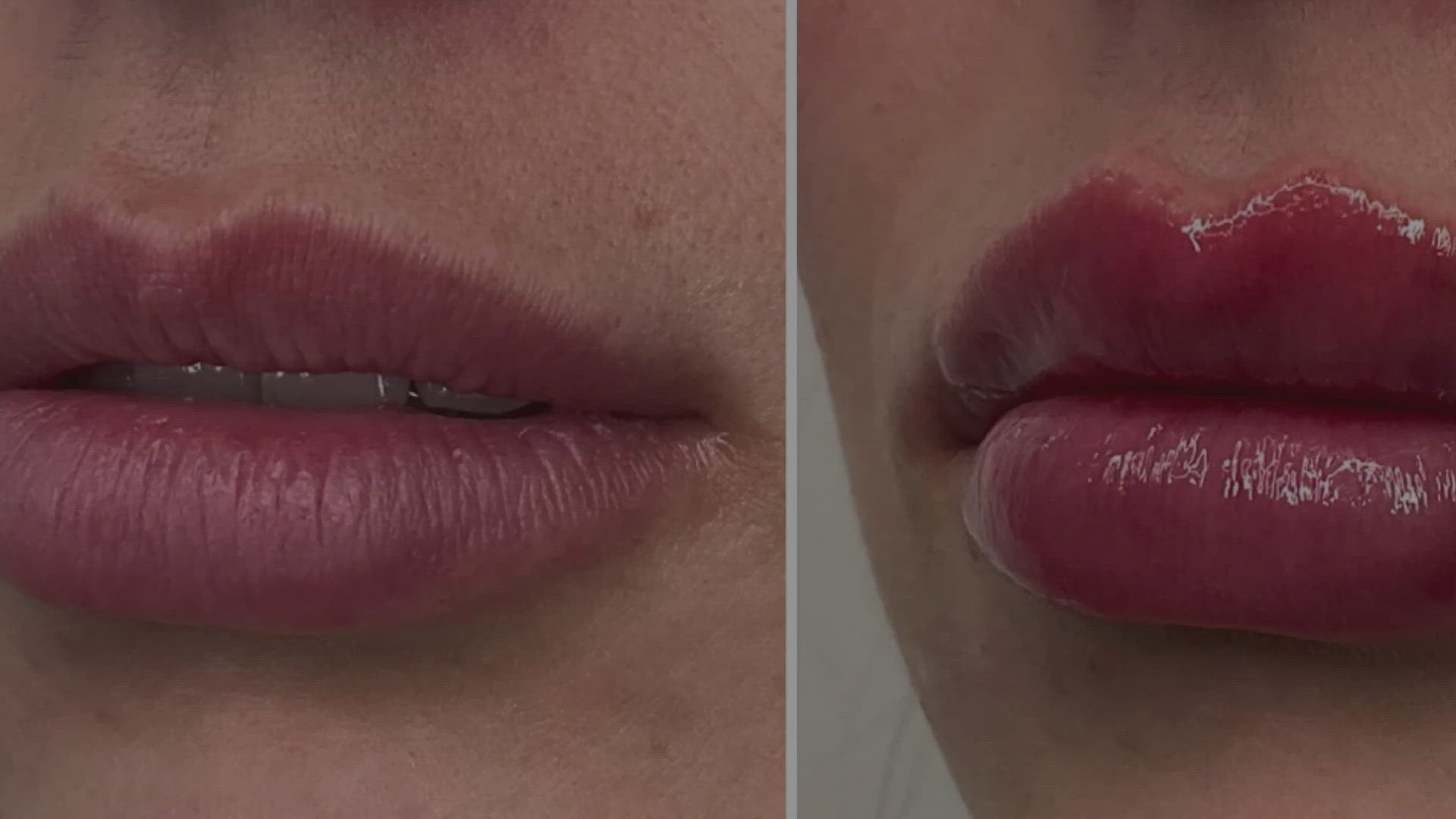 The Cosmetic Fillers Boom: What Are the Side Effects? | wusa9.com