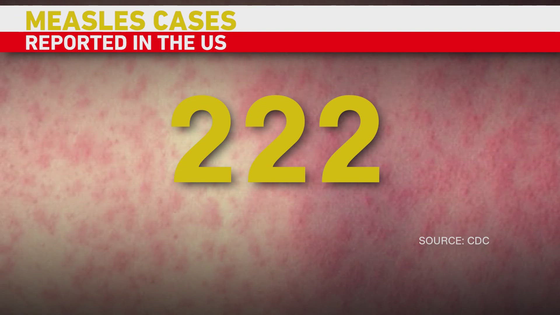 Measles cases in 12 states, mostly in Texas and New Mexico | wusa9.com