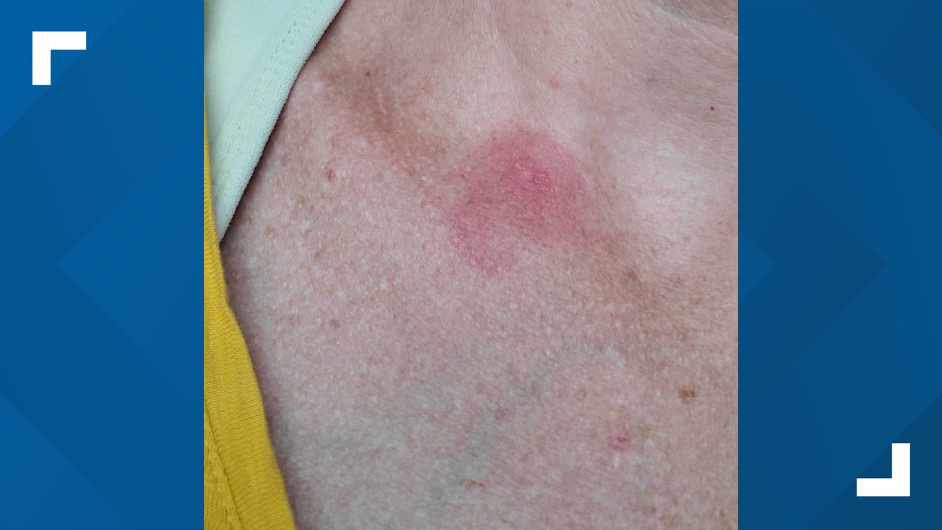 Bug bites stump Arlington health officials | wusa9.com