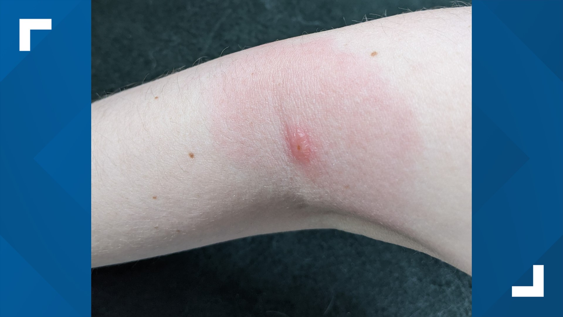 Bug bites stump Arlington health officials | wusa9.com