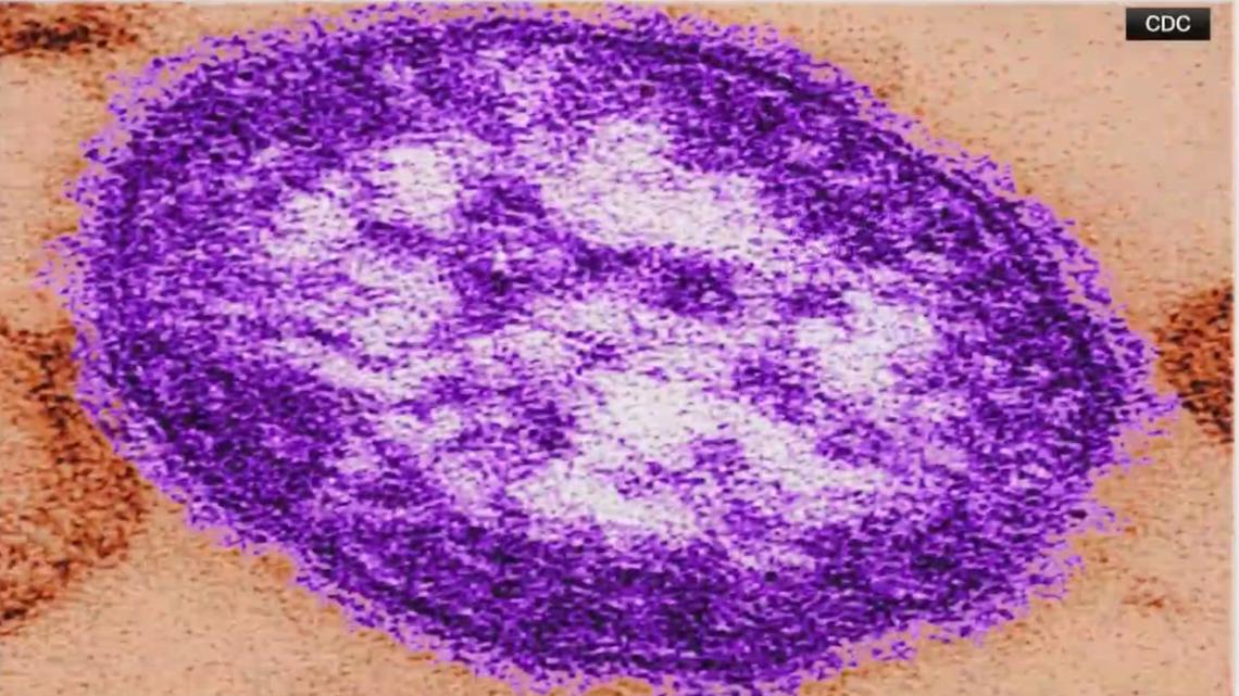 Record high measles cases in 30 years | wusa9.com