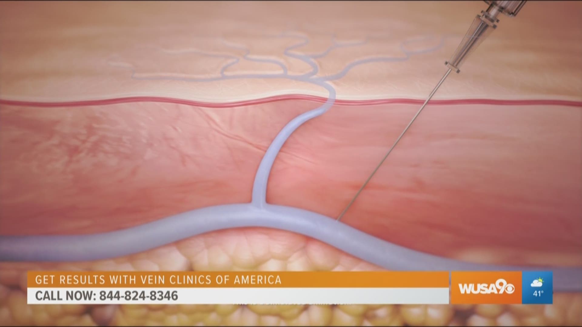 Learn about vein disease treatment options from Vein Clinics of America ...
