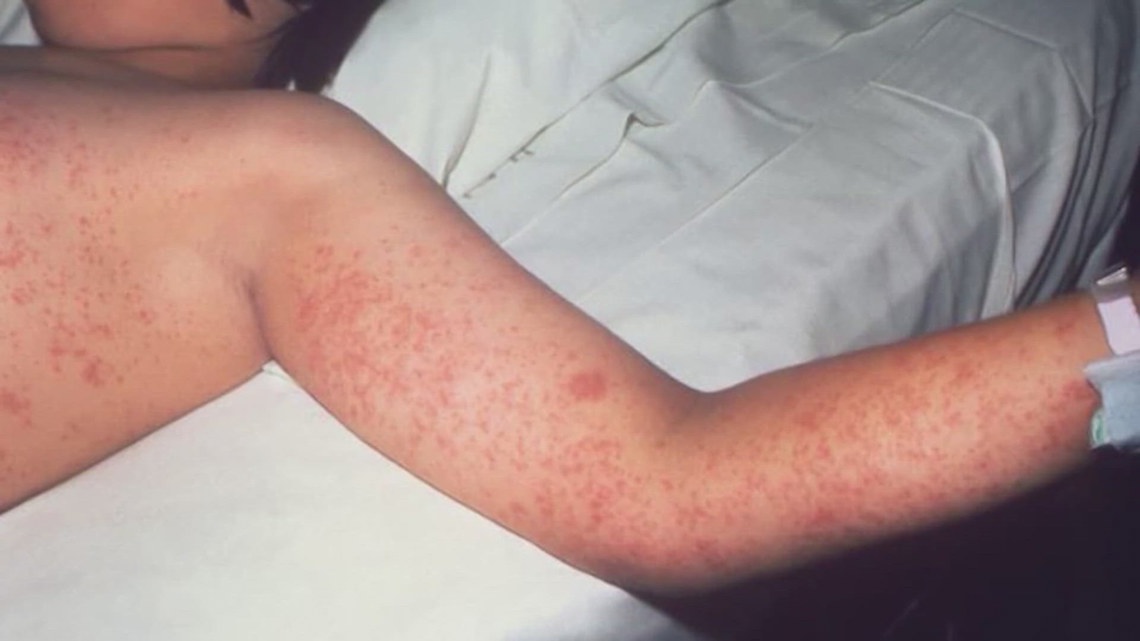Measles: Signs, symptoms and vaccines | wusa9.com